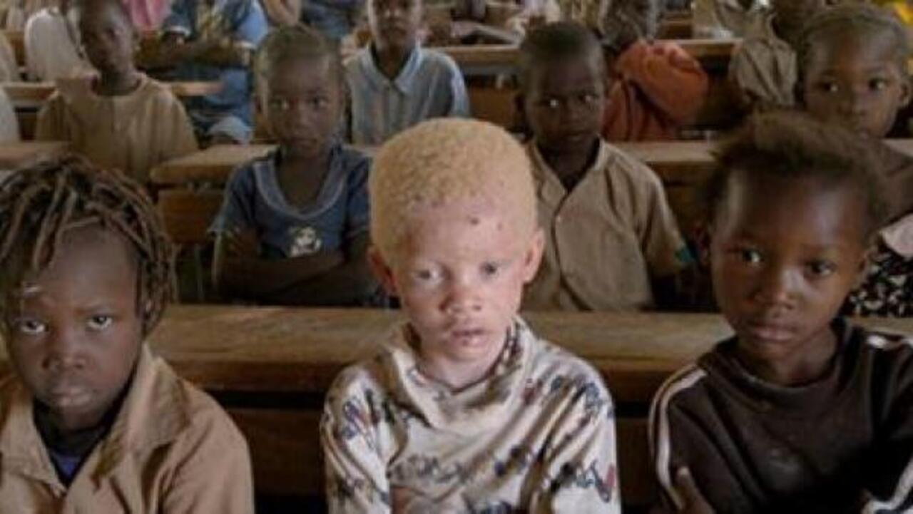 Moçambique: discriminação dos albinos continua a ser o grande desafio - RFI