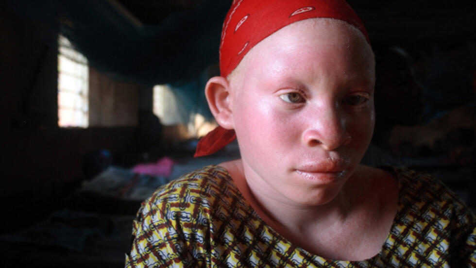 Albinos in Nigeria fight back - International report