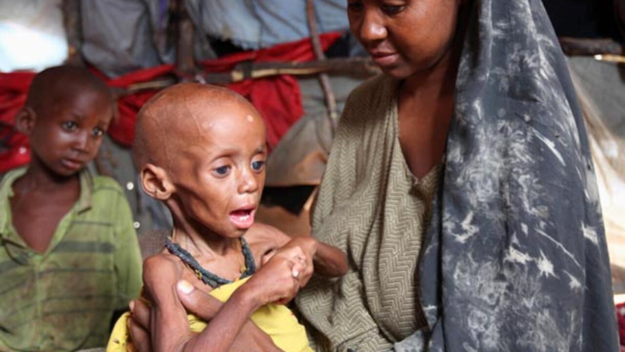 Somalie: des milliers d'enfants menacés de mort par la sécheresse