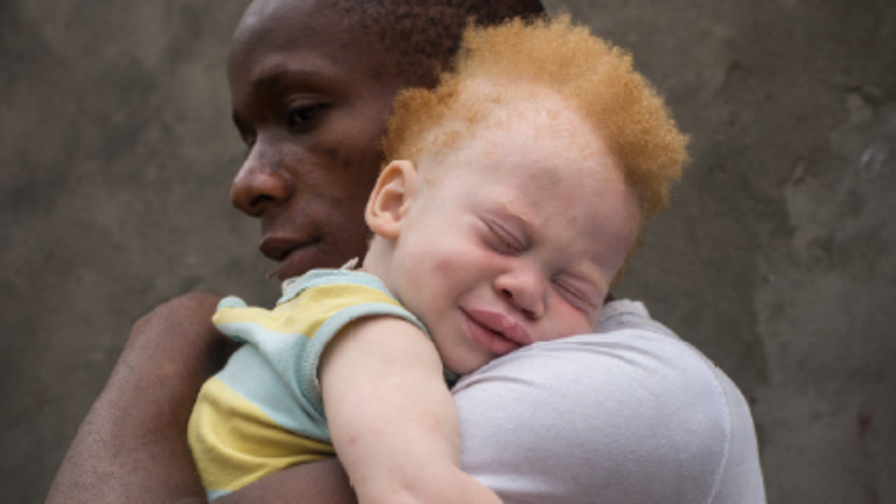 Qu'est-ce que l'albinisme ? - Le conseil santé