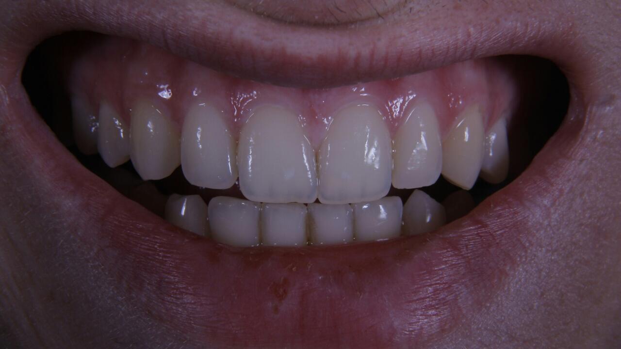 Soins des dents : quels facteurs peuvent favoriser l'apparition de ...