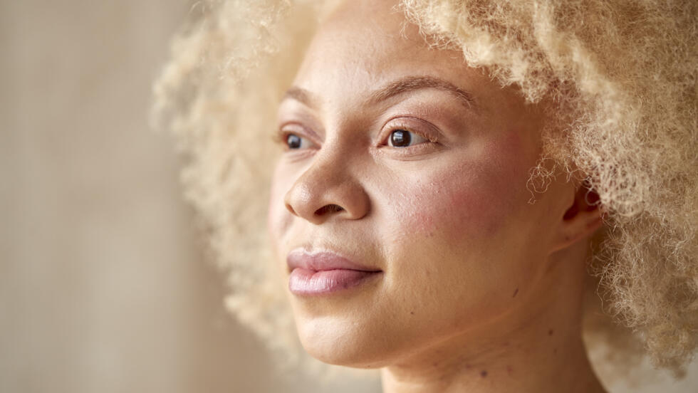 Albinisme: quelles précautions pour éviter un cancer de la peau? - Le ...