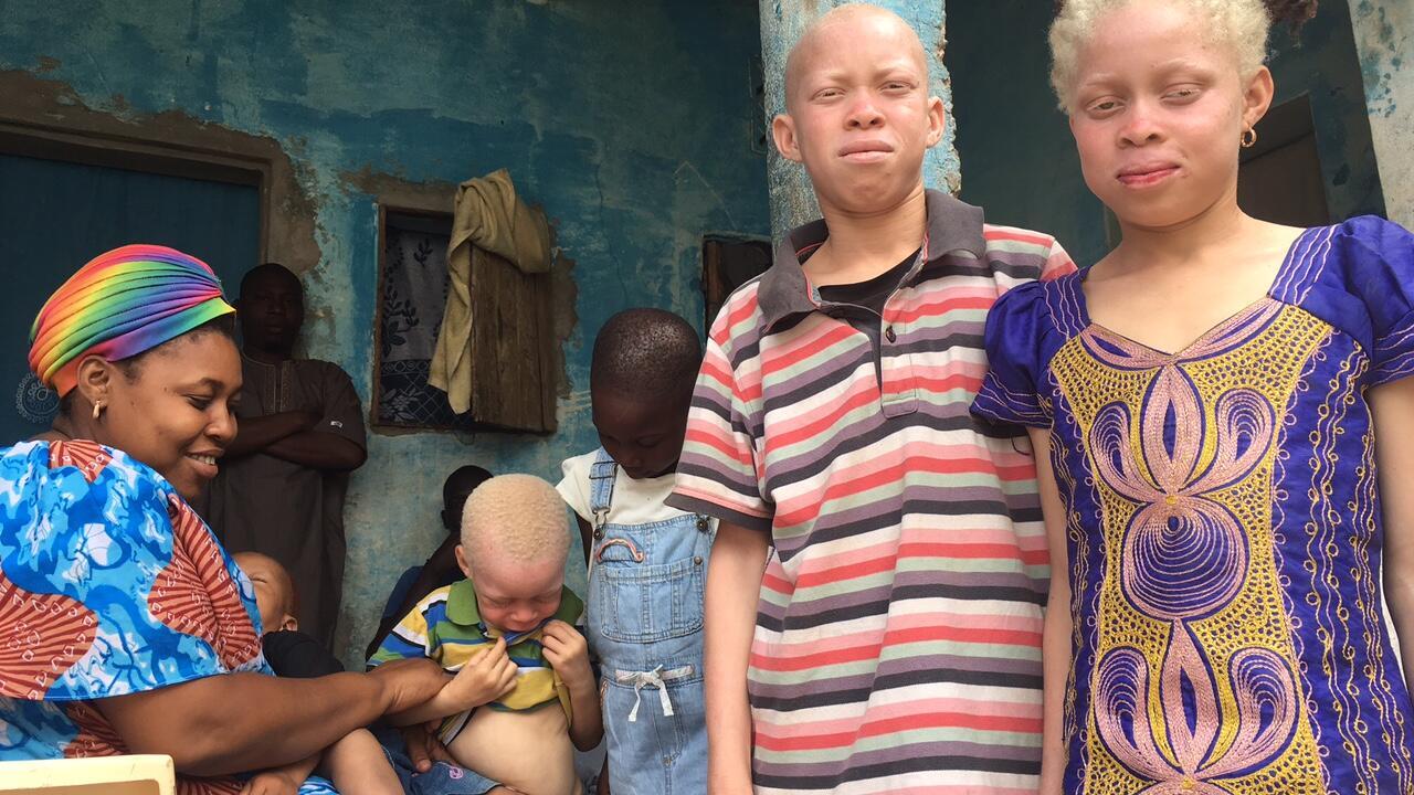 Albinos fight for their own sunscreen factory in Senegal ...
