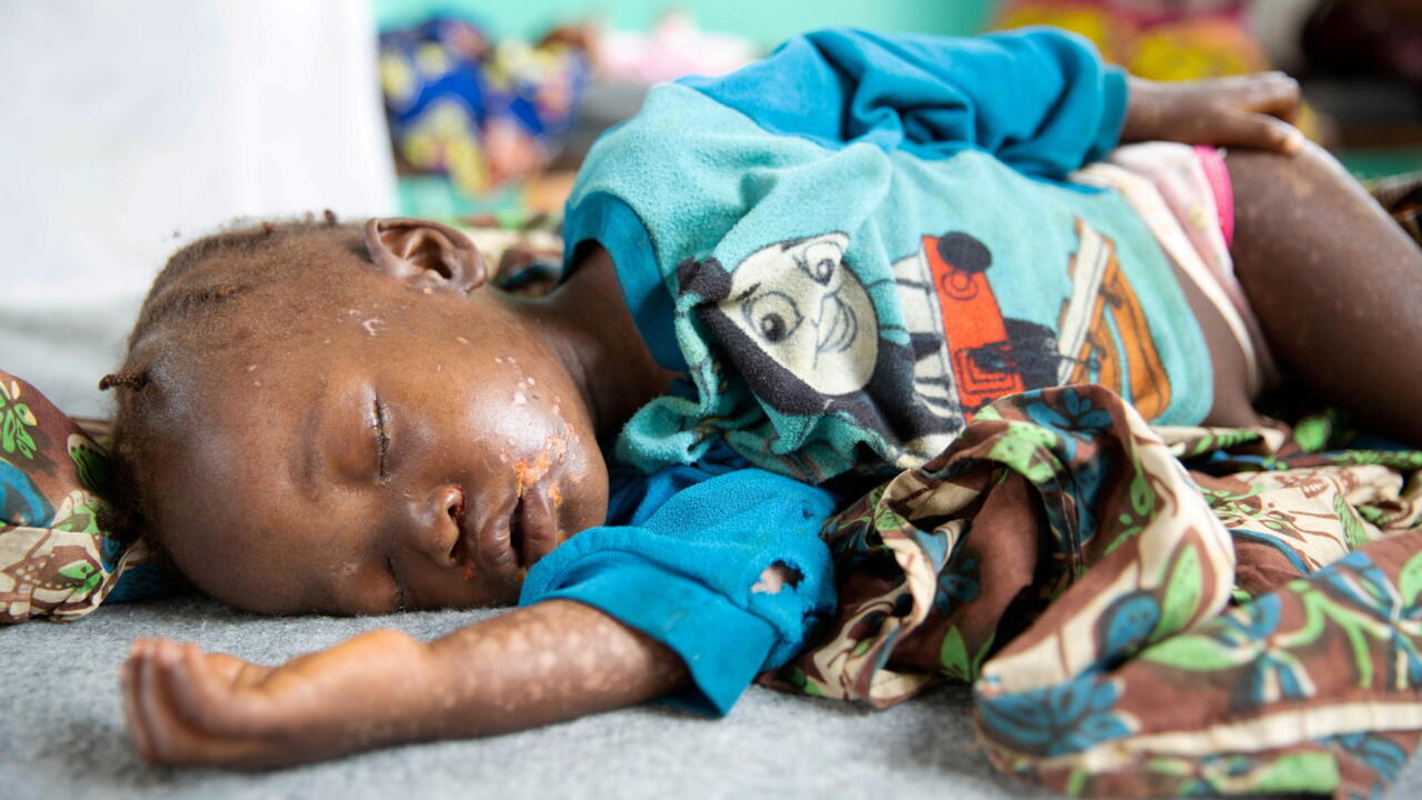 Kyanda ta kashe kananan yara 157 cikin mako guda a Zimbabwe