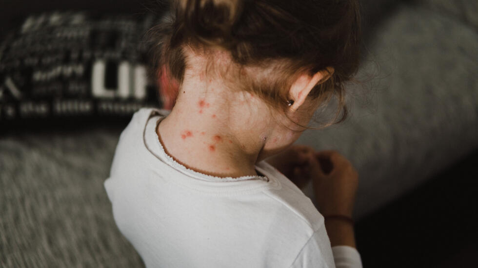 La rougeole: une maladie très contagieuse et pourtant évitable ...