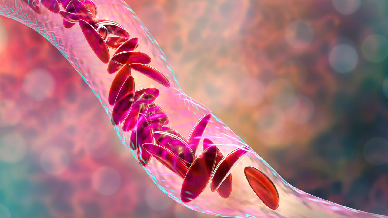 La drépanocytose - Priorité santé