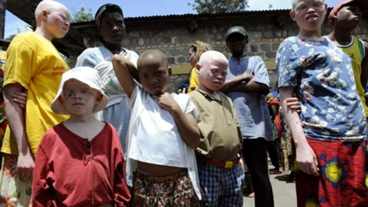 A Kinshasa, les albinos disent: «fièrement Ndundu!»