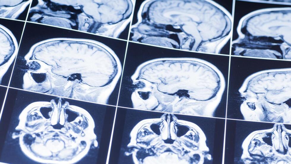 Vaincre l’AVC: le reconnaître, en guérir et le prévenir - Priorité santé