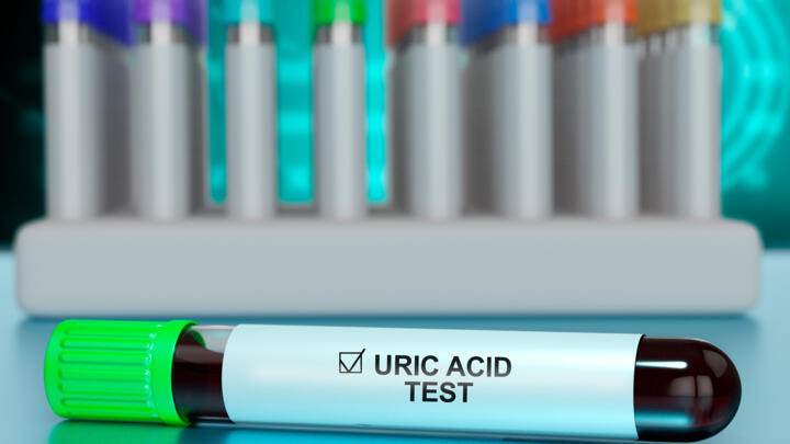 Alimentation : comment réduire l’acide urique dans le sang pour éviter ...