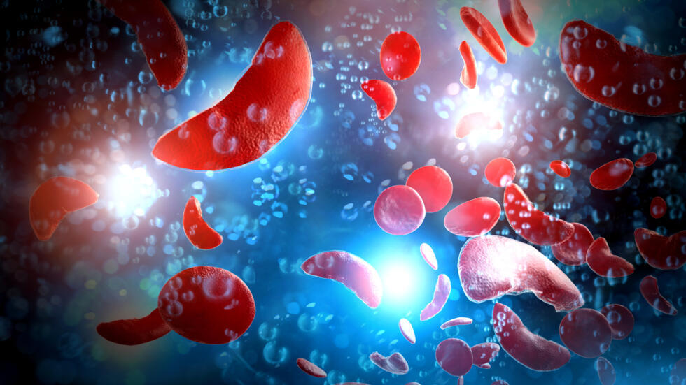 Drépanocytose: comment la prise en charge des enfants se déroule-t-elle ...