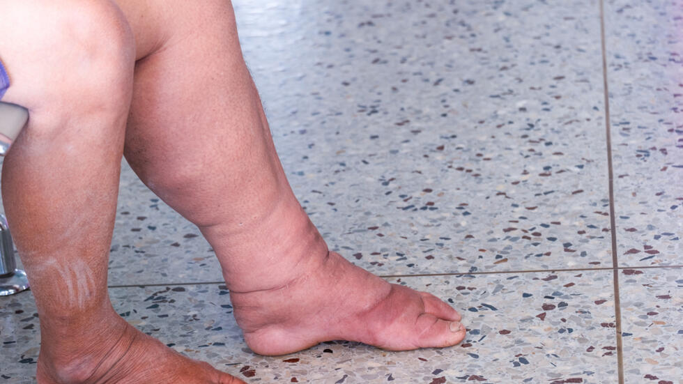 Éléphantiasis: une maladie tropicale handicapante et stigmatisante ...