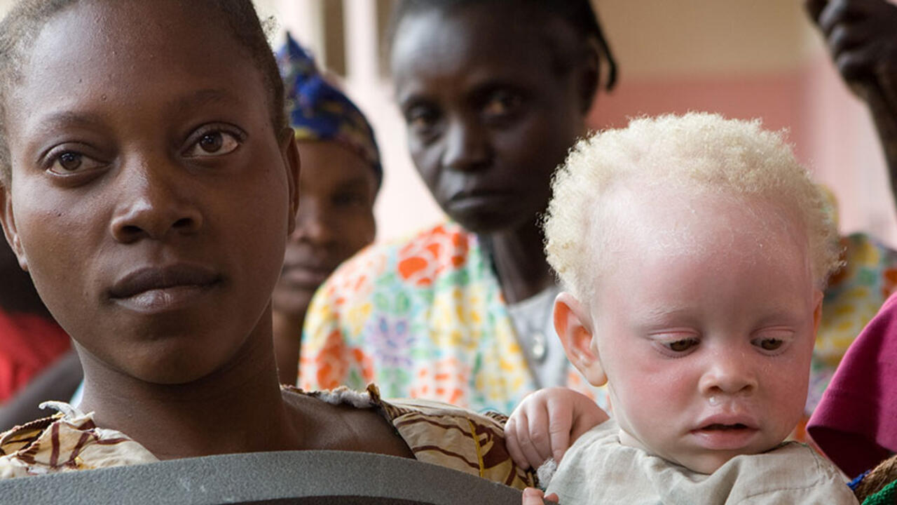 Afrique: «Les albinos sont considérés comme des êtres dotés de pouvoirs ...