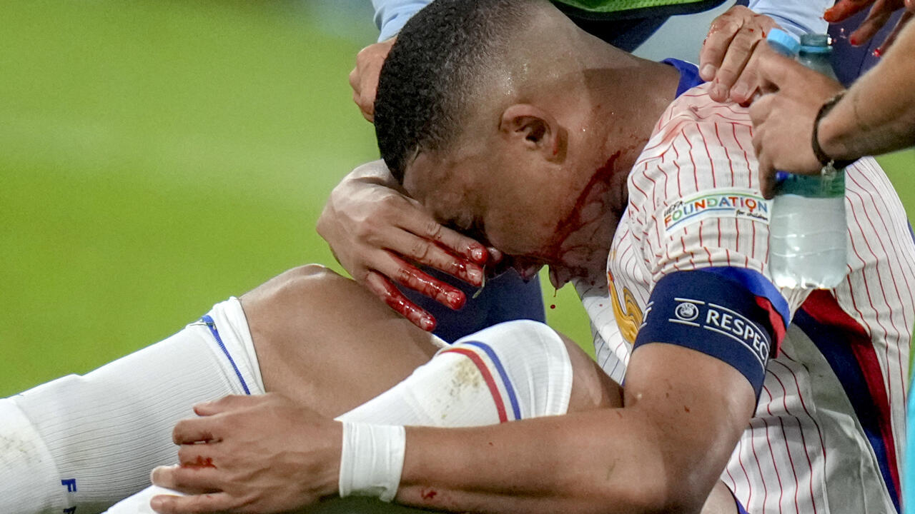 France team bosses sweat over Kylian Mbappé's facial injury